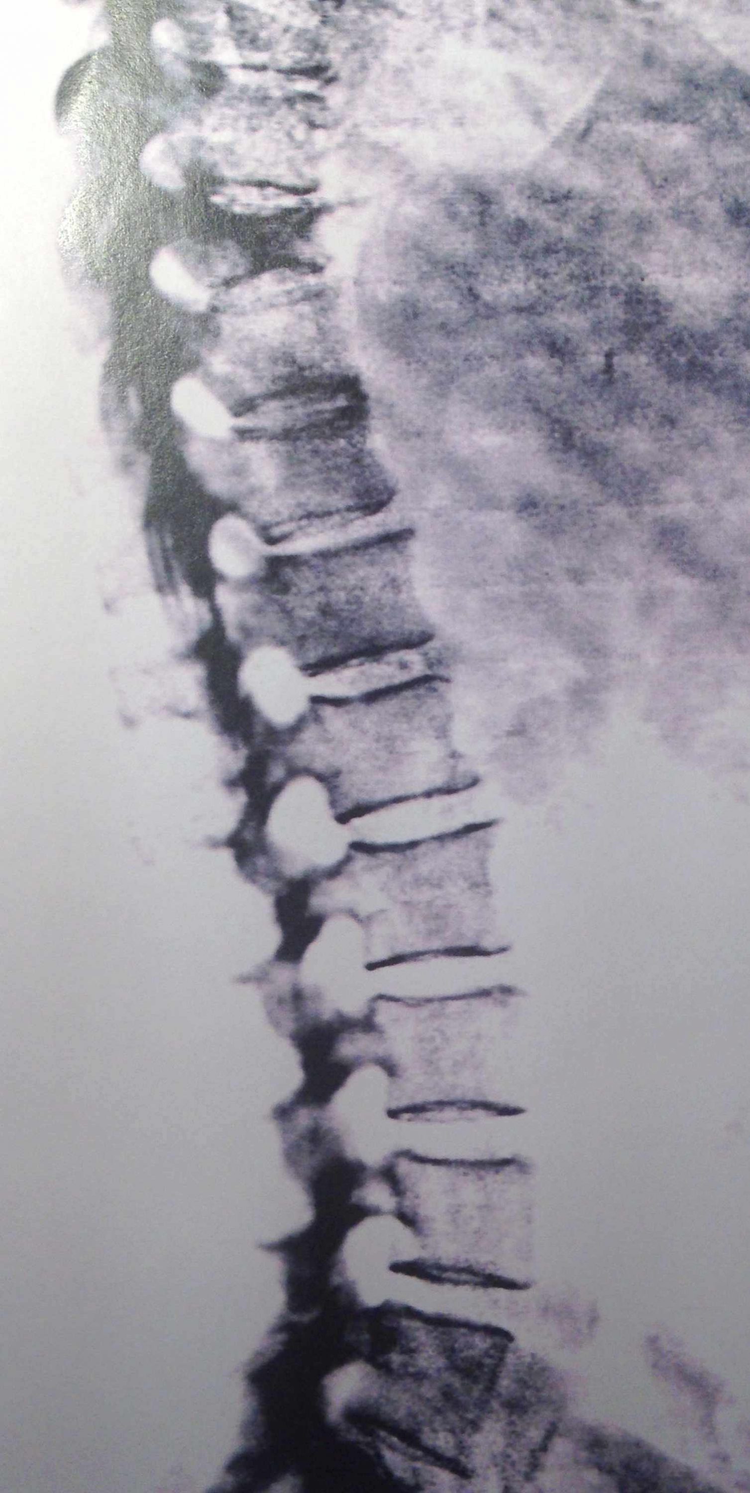 Vad är DXA - Svenska Osteoporossällskapet